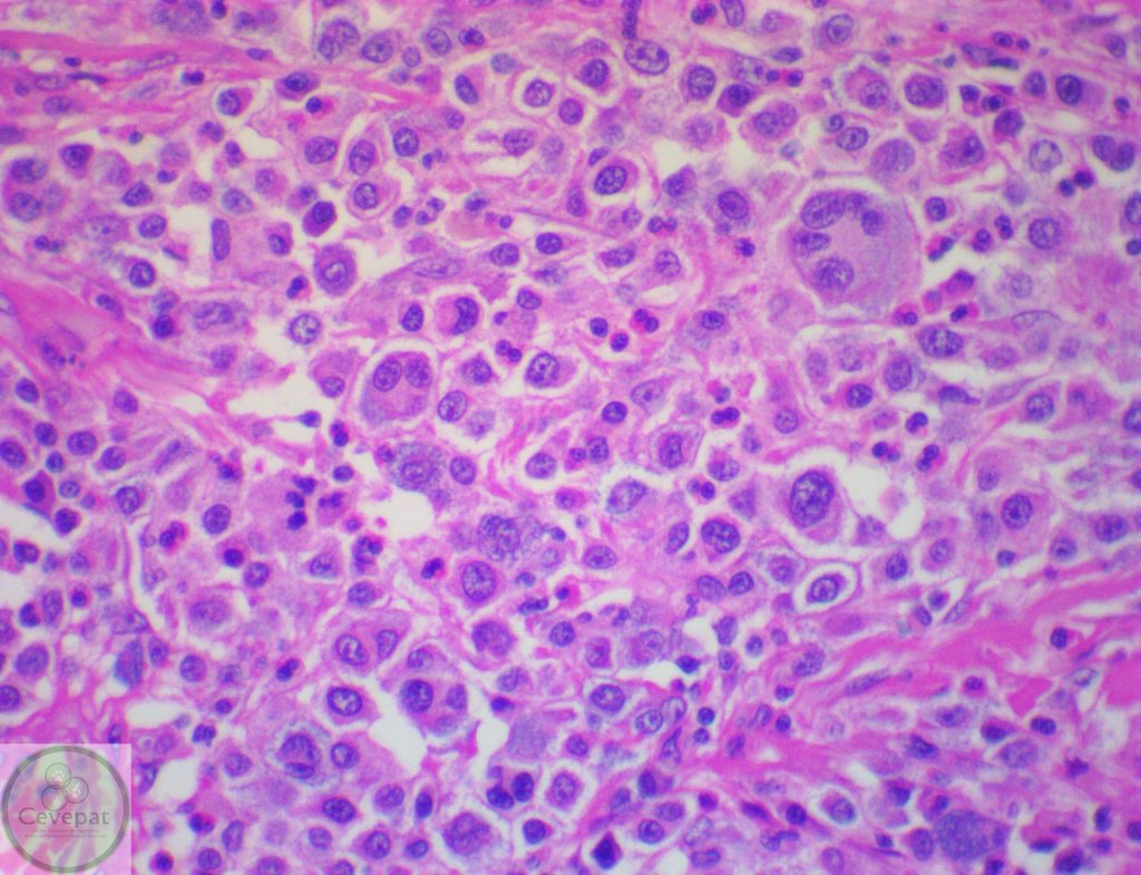 Mastocitoma Grau 2 Tem Cura - RETOEDU